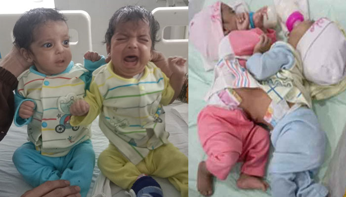 Doctors successfully separate conjoined twins in Pakistan - Daily Ausaf