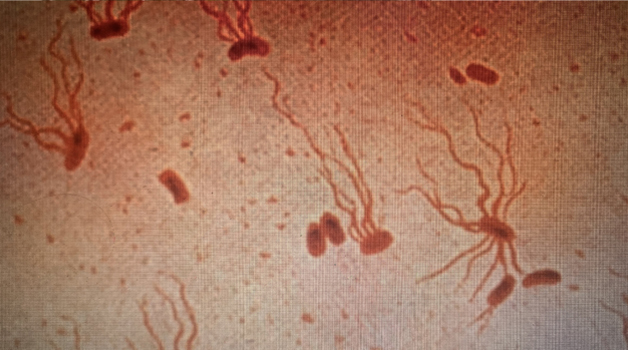 پریشان کن خبر ،ٹائیفائیڈ بخار میں مہلک تبدیلی، علاج کا آخری حل بھی ...